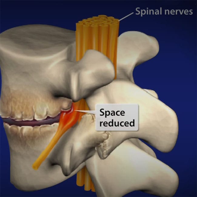 Lumbar Spondylosis Segura Neuroscience Pain Center Lumbar Spondylosis Segura Neuroscience Pain Center