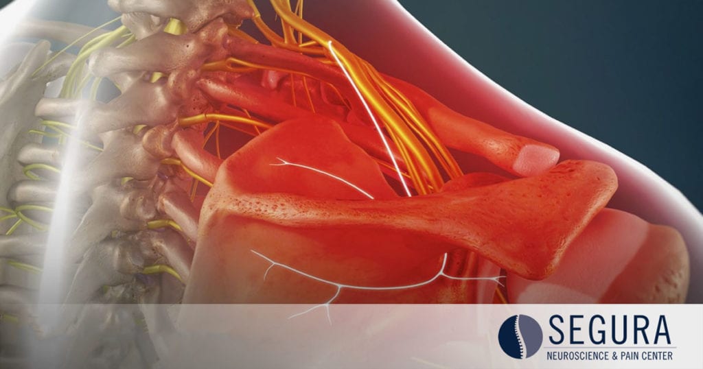 Chronic Shoulder Pain - Segura Neuroscience & Pain Center